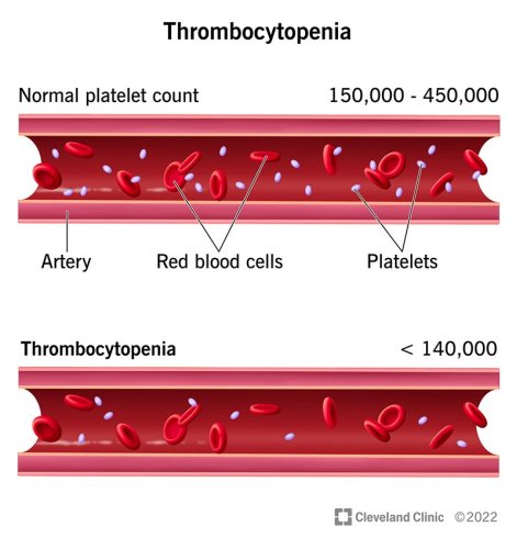 Thrombocytopenia: Symptoms, Stages & Treatment | Flipboard