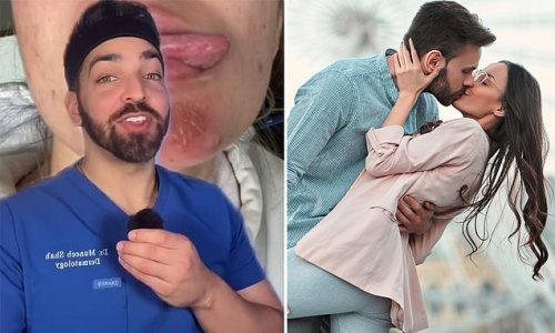 Dermatologists: This is why you should think twice before kissing any ...