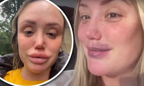 Charlotte Crosby displays bruised lips after getting her filler ...