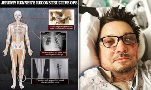 How Jeremy Renner's body had to be reconstructed: Metal plates hold his ...