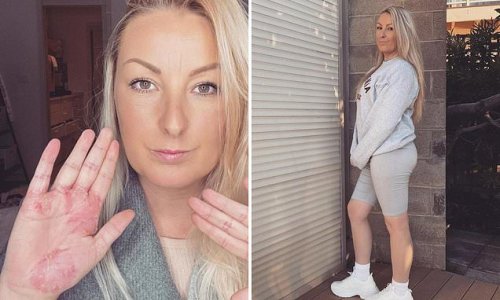 Aussie mum reveals the horror of living with a rare eczema skin ...
