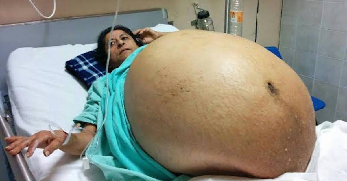 Mom's Weight Soars to 275 Pounds Due to 132-Pound Ovarian Tumor | Flipboard