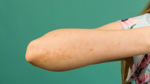 What's Really Causing Those Bumps On Your Elbows | Flipboard