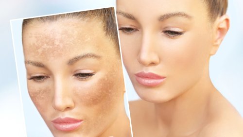 Body Hyperpigmentation: What Is It And Why Does It Happen? - Glam ...