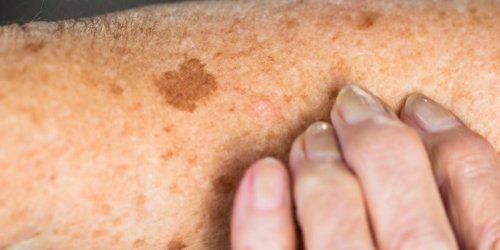How to differentiate harmless sunspots from skin cancer - Flipboard