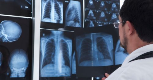 Young Doctor Diagnosed With Lung Cancer Urges Public To Know Deadly young-doctor-diagnosed-with-lung-cancer-urges-public-to-know-deadly