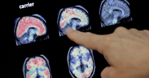 Alzheimer s Association Scientist Talks About The Latest Research On alzheimer-s-association-scientist-talks-about-the-latest-research-on