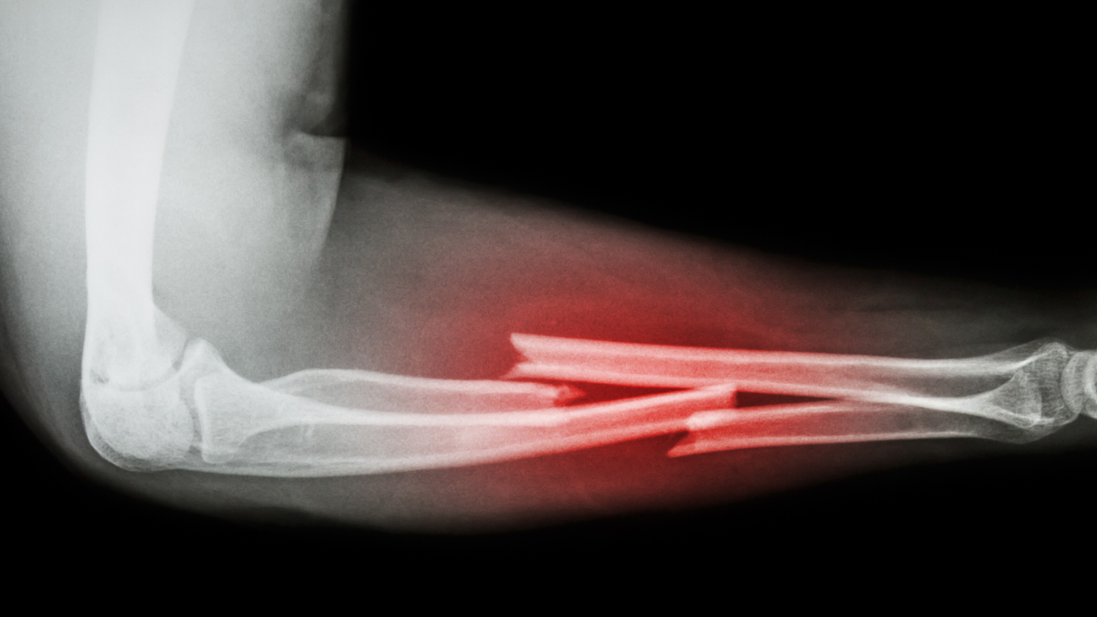 Doctor reveals what it means if you've never broken a bone as eerie ...