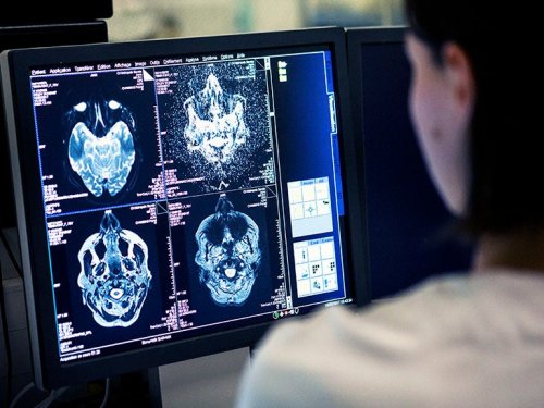 Sodium Selenate A Potential Future Treatment For Early onset Dementia sodium-selenate-a-potential-future-treatment-for-early-onset-dementia