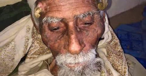 'World's oldest man' dies 'aged 140' after surgery to remove horn-like ...
