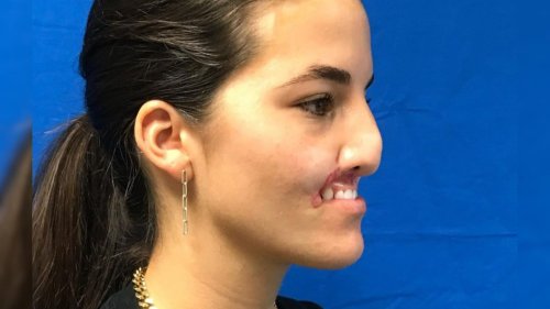 US Model who lost her lip in dog attack shares pictures of ...