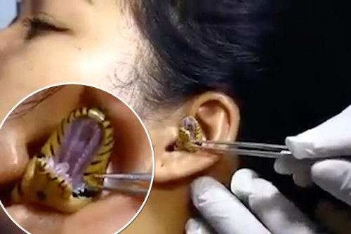 Surgeon Struggles To Remove Live Snake From Woman s Ear In Viral Video Flipboard surgeon-struggles-to-remove-live-snake-from-woman-s-ear-in-viral-video-flipboard