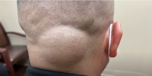 Dr Pimple Popper Squeezes Humongous Neck Lipoma That Oozes Mozzarella Substance Flipboard