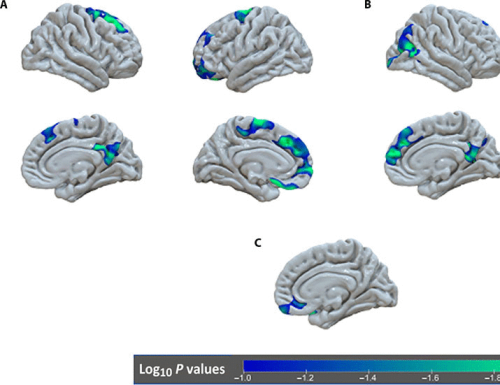 Early Deprivation Alters Structural Brain Development From Middle
