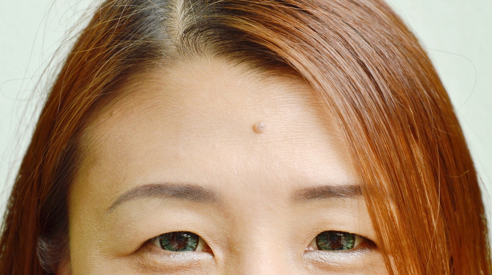 What It Means When You Have A Mole On Your Forehead | Flipboard