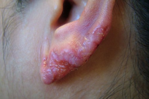 Symptoms of Skin Tuberculosis | Flipboard